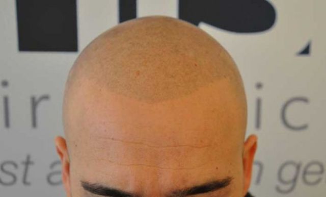 The ‘No Hair’ Solution! (9 pics) - Izismile.com